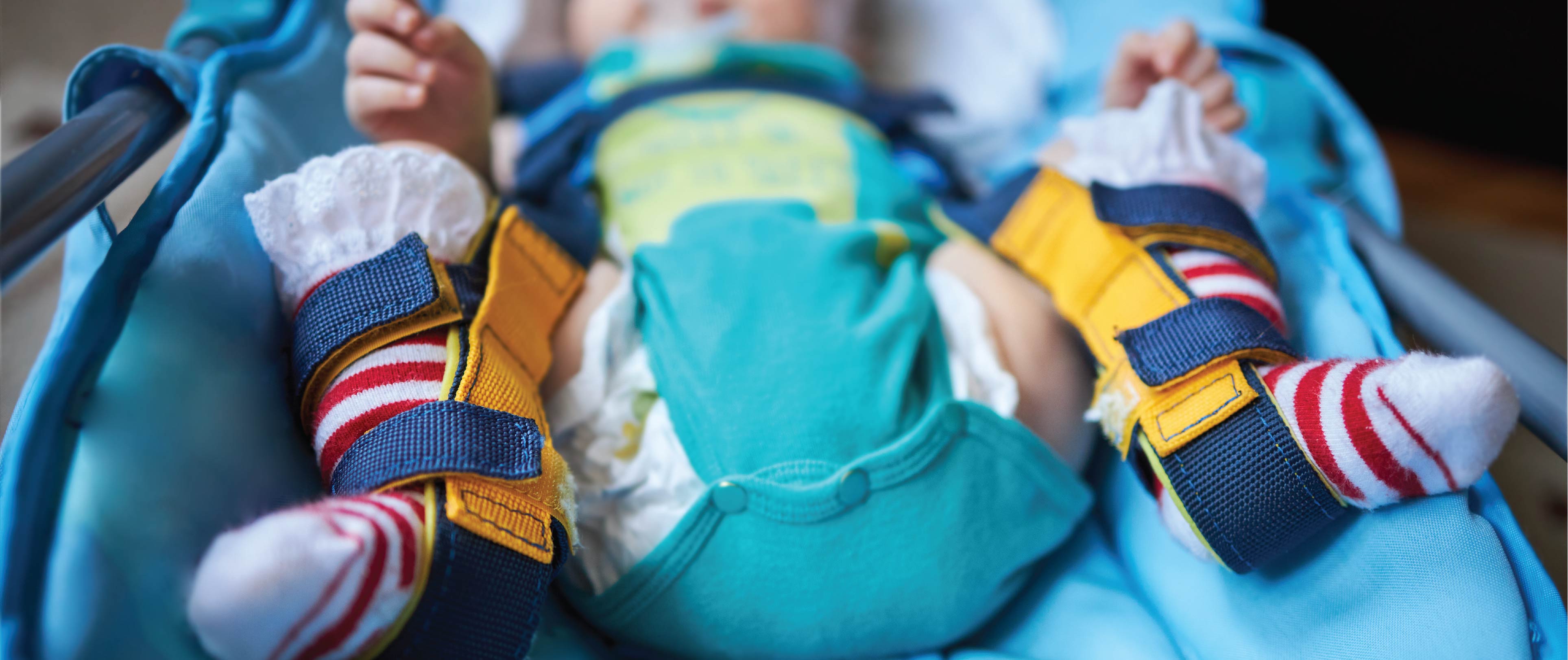 What Do You Need to Know About Developmental Dysplasia of Hip (DDH ...